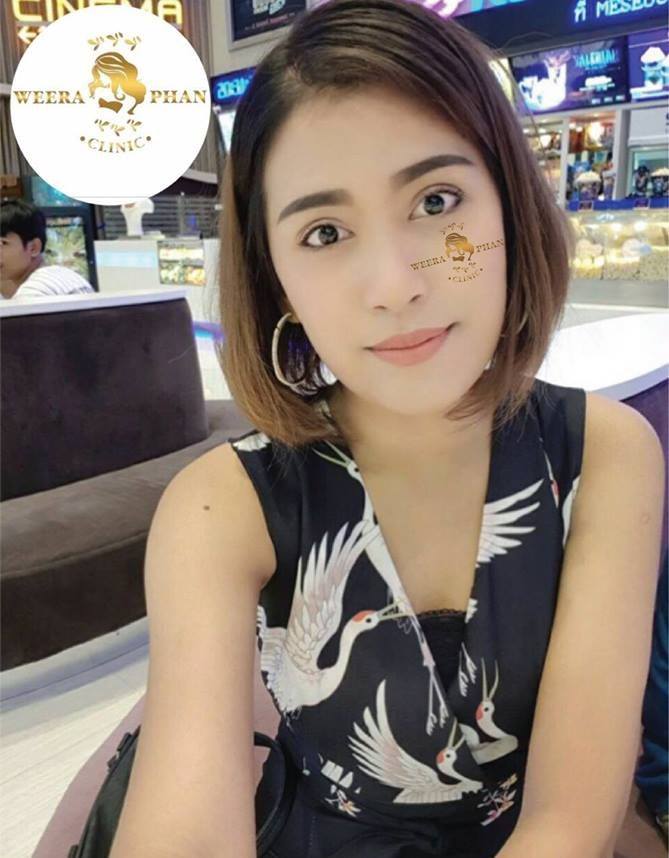 ตาสองชั้น - วีรพรรณ คลีนิก